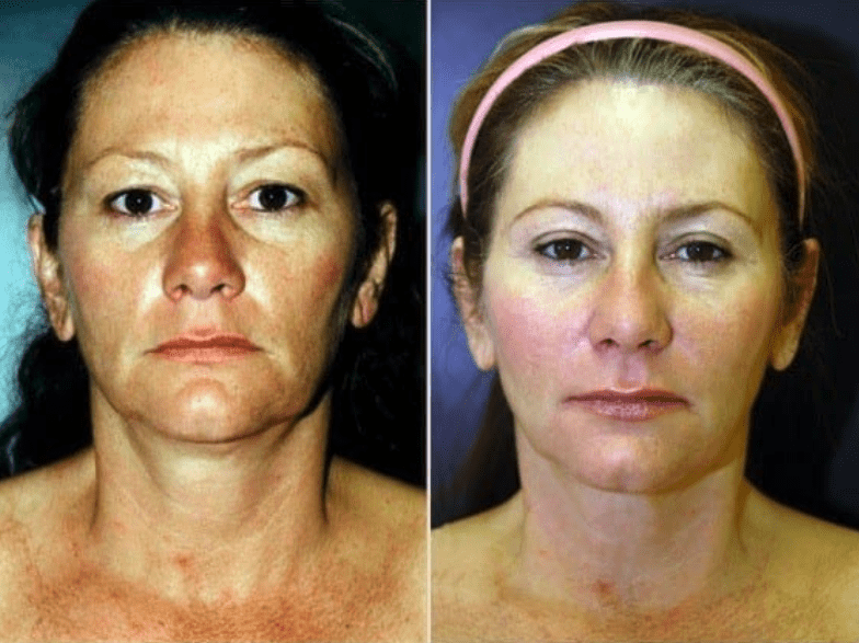 Thread Lift | Center for Cosmetic Surgery & MediSpa Baltimore