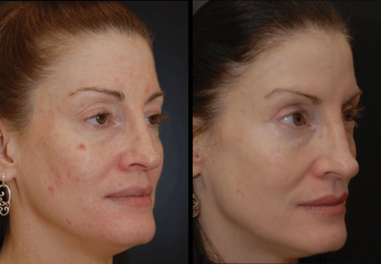 What To Expect After Pixel Laser Treatment At Doris Whitfield Blog